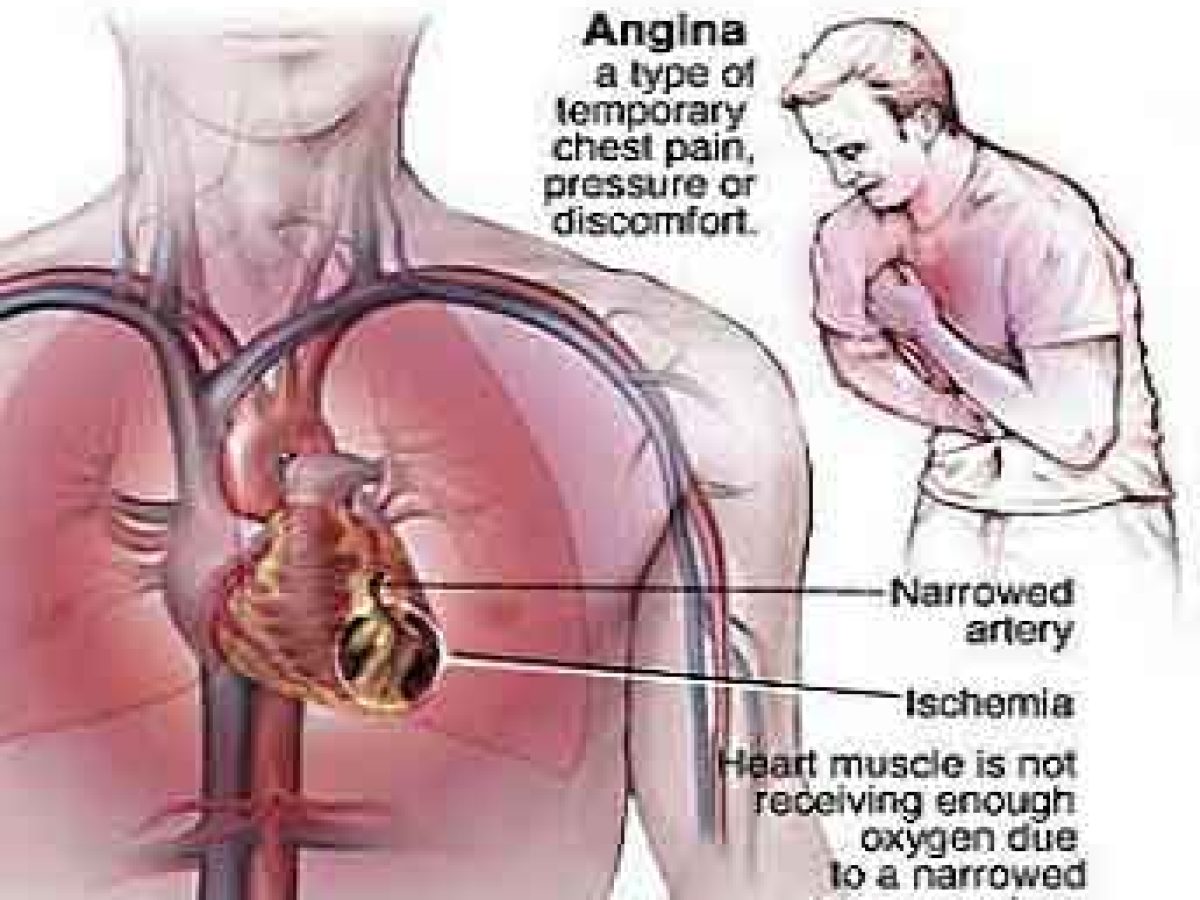 Angina Pectoris Angina Pectoris: Symptom And Causes MTatva